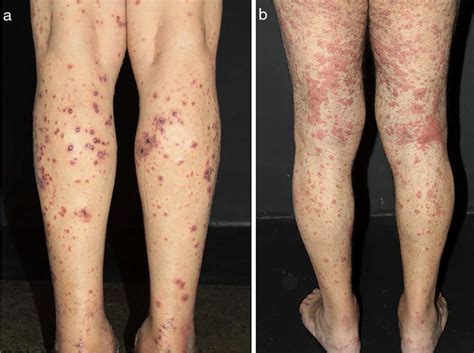 Vasculitis Of The Skin Pictures