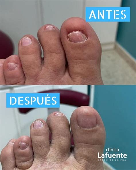 Reconstrucción de uñas Qué es y en qué casos se usa Clínica