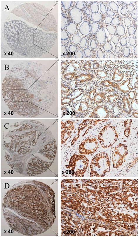 FTO Expression Is Associated With The Occurrence Of Gastric Cancer And