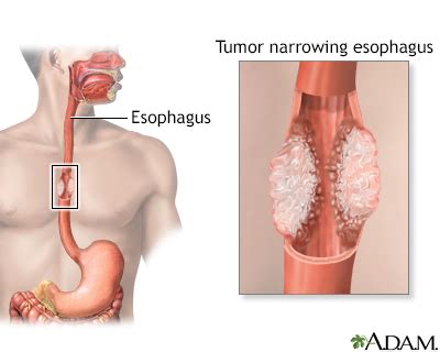 Esophageal Cancer Symptoms Doctors Treatments Advances More Medifind
