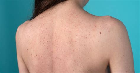 Helpful Ways On How To Get Rid Of Back Acne Scars 2024