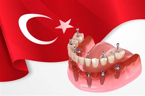 All On 6 Dental Implants In Turkey Technique Procedure