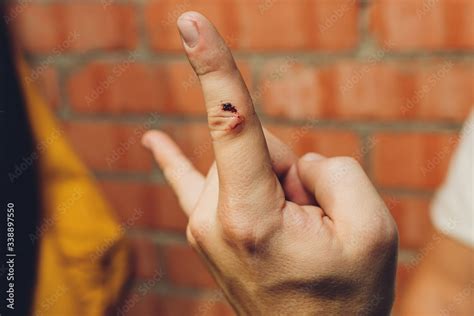 Bleeding Blood From The Cut Finger Wound Injured Finger With Bleeding