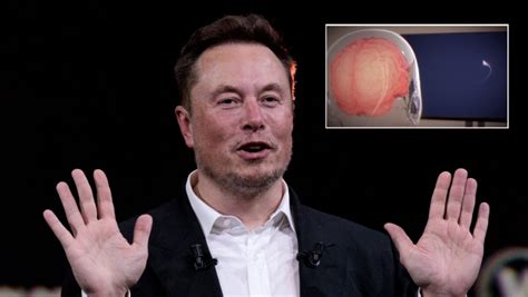Cómo funciona el chip Telepathy de Neuralink en el cerebro Grupo Milenio