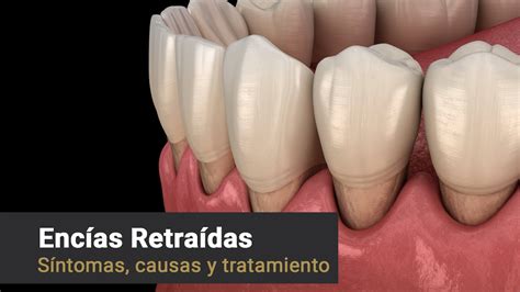 Provenza Clínica Dental Encías Retraídas Síntomas Causas y
