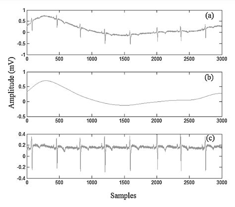 figure 1 from an efficient algorithm of ecg signal denoising using the adaptive dual threshold