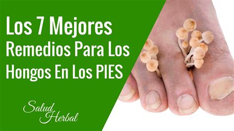 Los Mejores Remedios Para Los Hongos En Los Pies Tratamiento Para