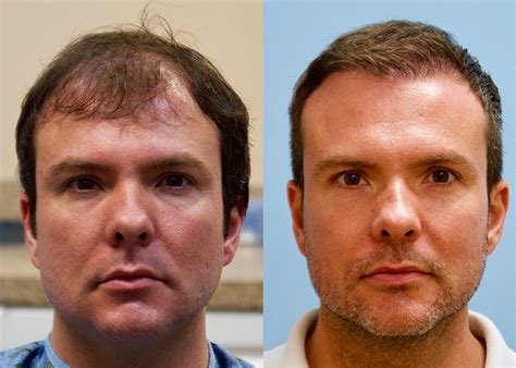 FUE Hair Transplant Case Study 2 Day 3500 Grafts Carolina Hair