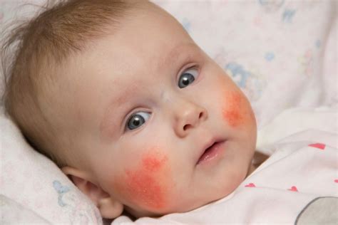 Dermatita atopică simptome și cauze PapTot ro Sarcină naştere
