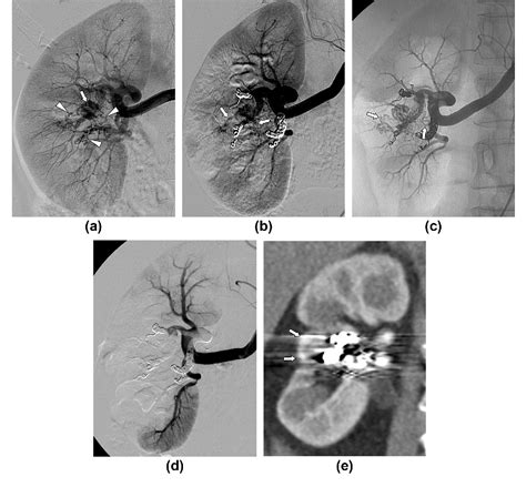 Figure 1 From Transarterial Embolisation Of Renal Arteriovenous