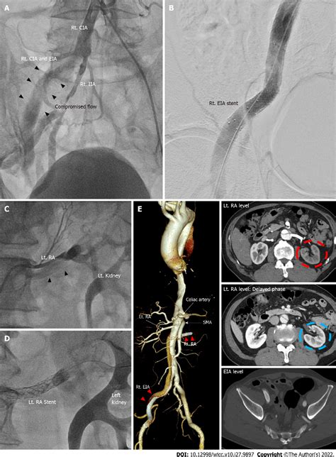 Figure From Iatrogenic Aortic Dissection During Right Transradial