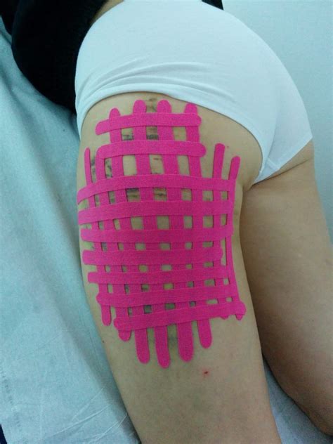 Vendaje Neuromuscular Kinesiotape O Kinesiotaping Indicaciones Y