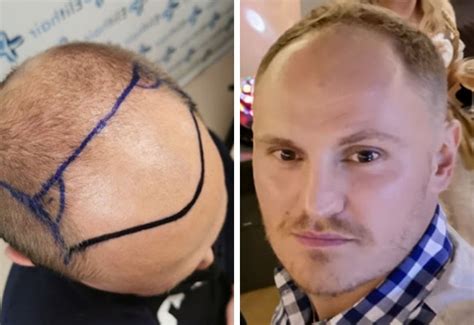 Tim H Before After Pictures 3500 Grafts Elithair