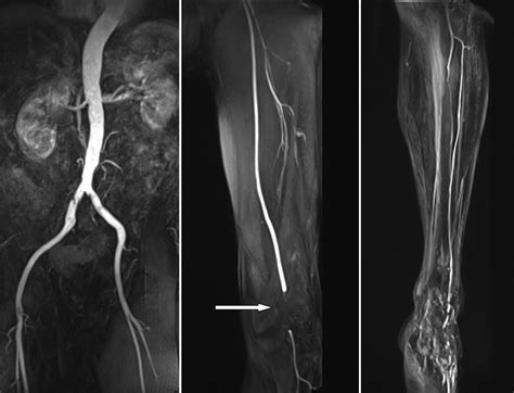 Endovascular Treatment Of Acute Limb Ischemia Secondary To Fracture Of