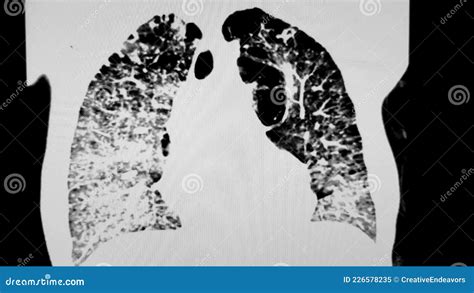 COVID 19 With Bullous Emphysema Chest CT Scan Of VIdeo Stock Video