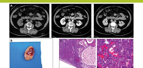 Masses rénales et indication à la néphrectomie Clinique et bilan