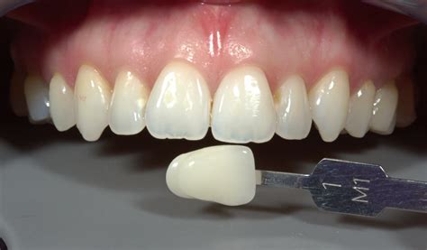 LA IMPORTANCIA DE LA FOTOGRAFÍA DENTAL Clinica Dental Moaña Dr