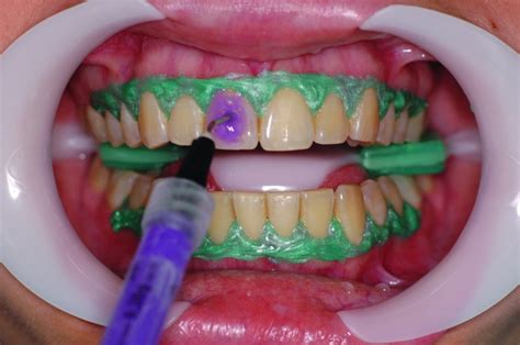Entenda Tudo Sobre Clareamento Dental Laser Odonto