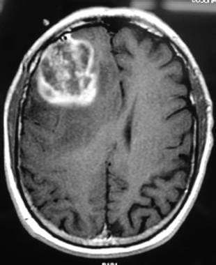 Glioblastoma Multiforme Imaging Practice Essentials Computed