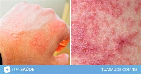 Manchas Rojas En La Piel Causas Y Como Eliminarlas Maestria Salud
