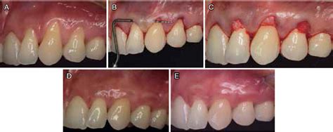 Tratamiento De Recesiones Gingivales M Ltiples Clase I Y Iii De Miller