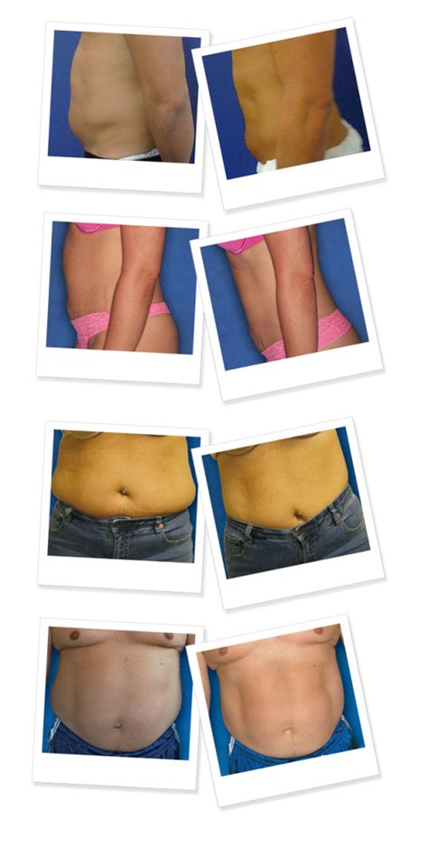Body Contouring Zerona Cunico Health And Wellness