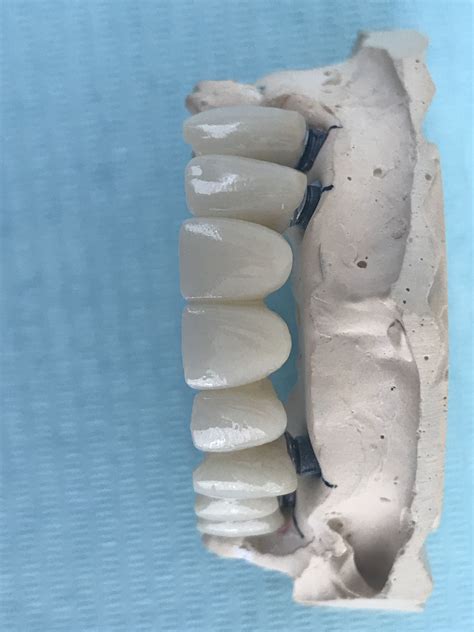 Reabilitação Oral Prótese Fixa sobre Implantes Dentários