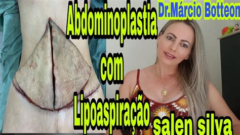 Abdominoplastia Lipoescultura E Enxertia Nos Gluteos YouTube