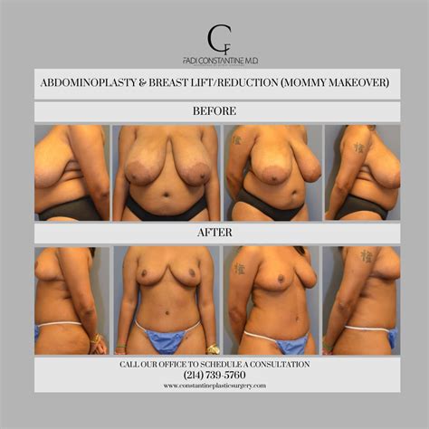 Breast Reduction Before And After Ddd