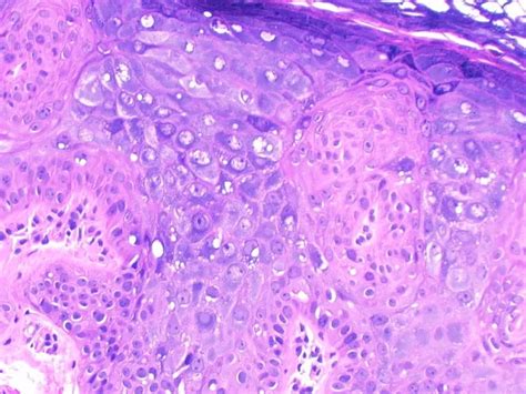 Epidermodysplasia Verruciformis Microscopic