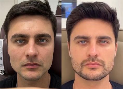 Notícias Harmonização facial é reversível 8 mitos e verdades sobre o