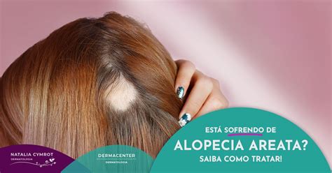 Está sofrendo de Alopecia Areata Saiba como tratar Clínica Natalia