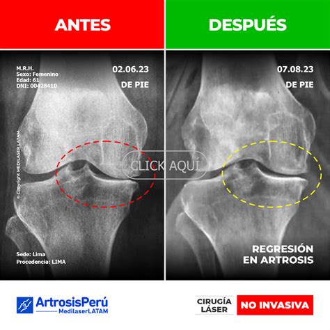 Evidencias Artrosis Per