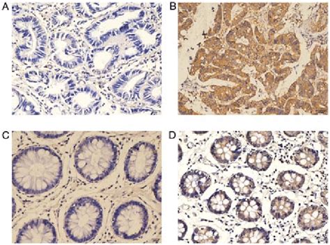 Immunohistochemical Staining Of CXCL3 In Colon Cancer CXCL3 Signaling