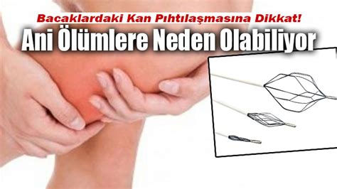 Bacaklardaki Kan Pıhtılaşması Ani Ölümlere Neden Olabiliyor KGRT