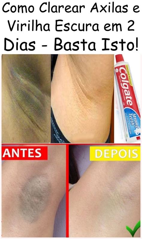 Como Clarear Axilas E Virilha Escura Em 2 Dias Basta Isto Clarear