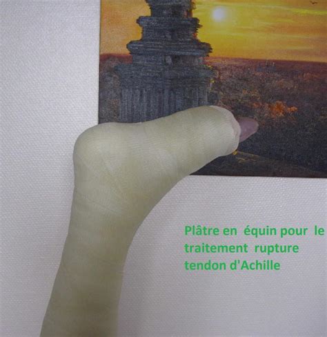 Rupture Du Tendon D Achille Tendinite Du Tendon D Achille Suture Tendon