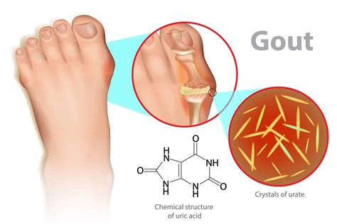 Gout Treatment Symptoms Podiatrist Near Me Beaver Valley Foot Clinic