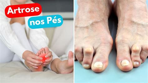 ARTROSE NOS PÉS Dr Prof Nelson Marques YouTube