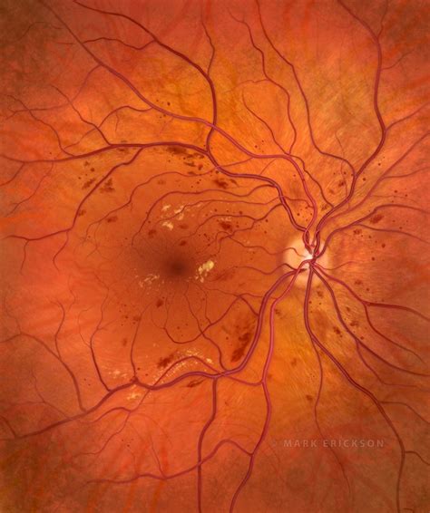 Nonproliferative Diabetic Retinopathy Npdr Retina Medical Illustration
