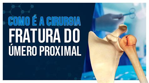 FRATURA DO ÚMERO PROXIMAL COMO É A CIRURGIA YouTube