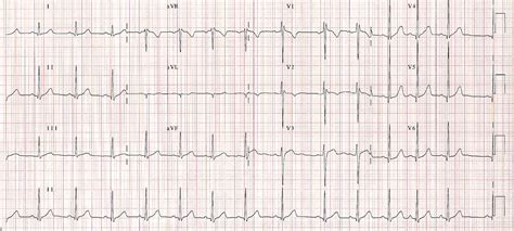 Continuum Guía sistemática de lectura del ECG pediátrico