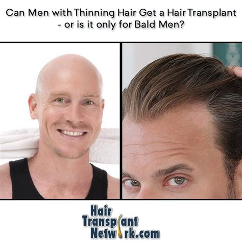 How To Stop Thinning Hair Male Reddit A Comprehensive Guide The 2023