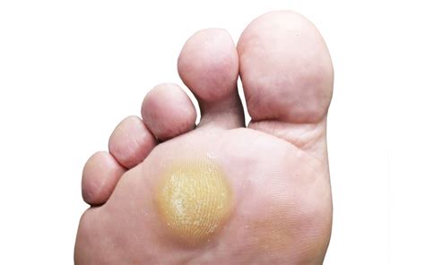 Ojo de gallo en el pie heloma plantar y dorsal Tratamiento y prevención