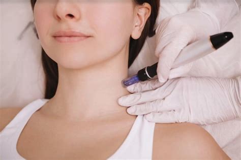 Dermapen Qué es Beneficios y Tratamientos Clínica Vladimir Rovira