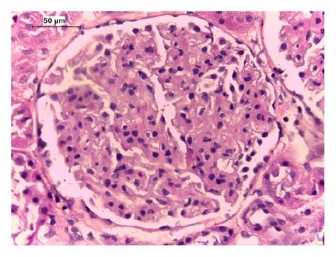 Histology Of The Patient Renal Biopsy A Proliferation Of Mesangial