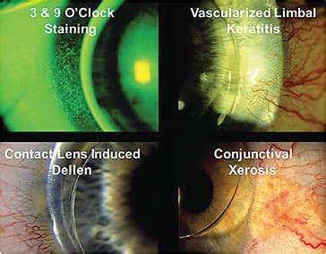 CONTACT LENS CASE REPORTS Contact Lens Spectrum