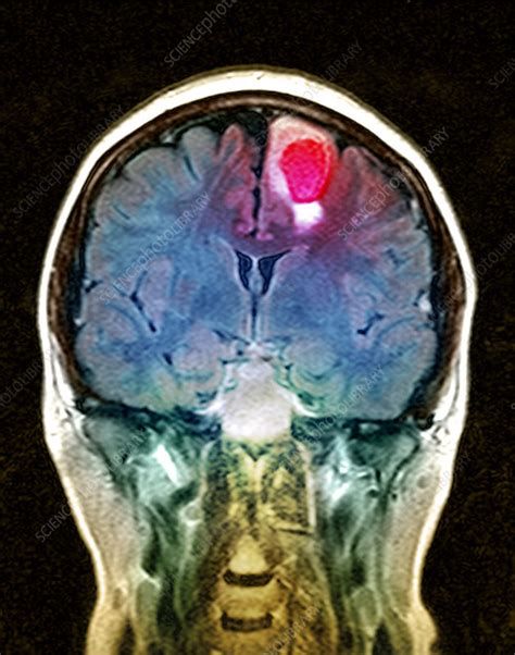 Brain Tumour MRI Scan Stock Image M134 0863 Science Photo Library