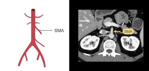 Abdominal CT Abdominal Arteries LITFL Radiology Library