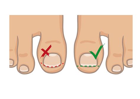 Podiatrist Ingrown Toenail Removal Non Invasive Surgery Treatment